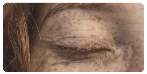 Removee - Depil & Laser | Depilação a laser em Blumenau